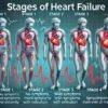 5 Early Signs Of Heart Failure In Women (Causes+Treatment)